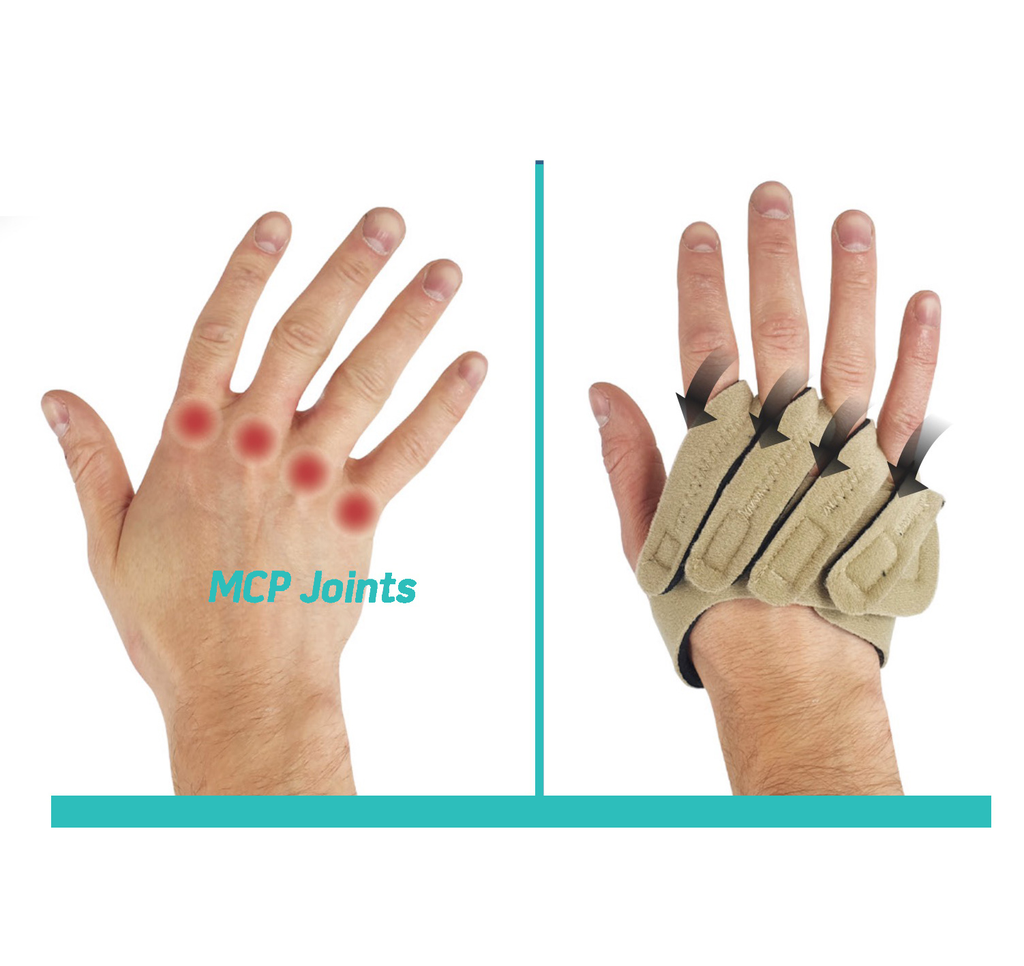 Neoprene Ulnar Drift Splints